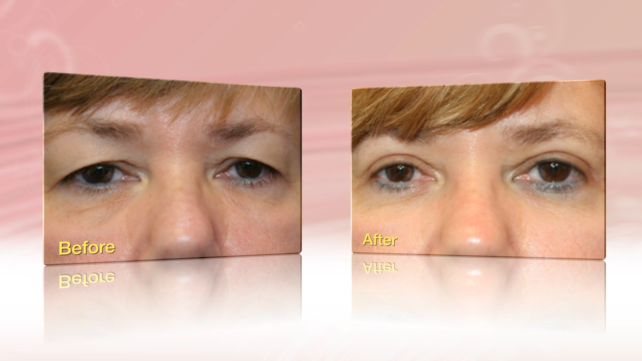 What Is Kaiser Vision Essentials at Exie Long blog